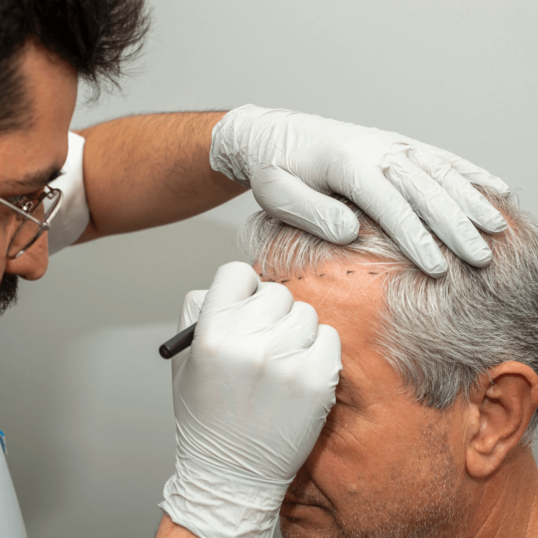 TRANSPLANTE CAPILAR - HD CLINIC - Clínica Médica Estética e Dentária
